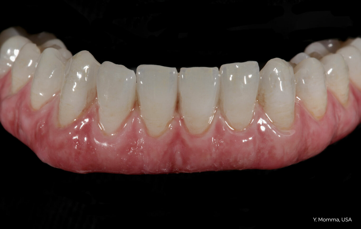 IPS e.max ZirCAD Prime | IPS e.max ZirCAD Prime Esthetic | Restauri in ossido di zirconio| Ivoclar